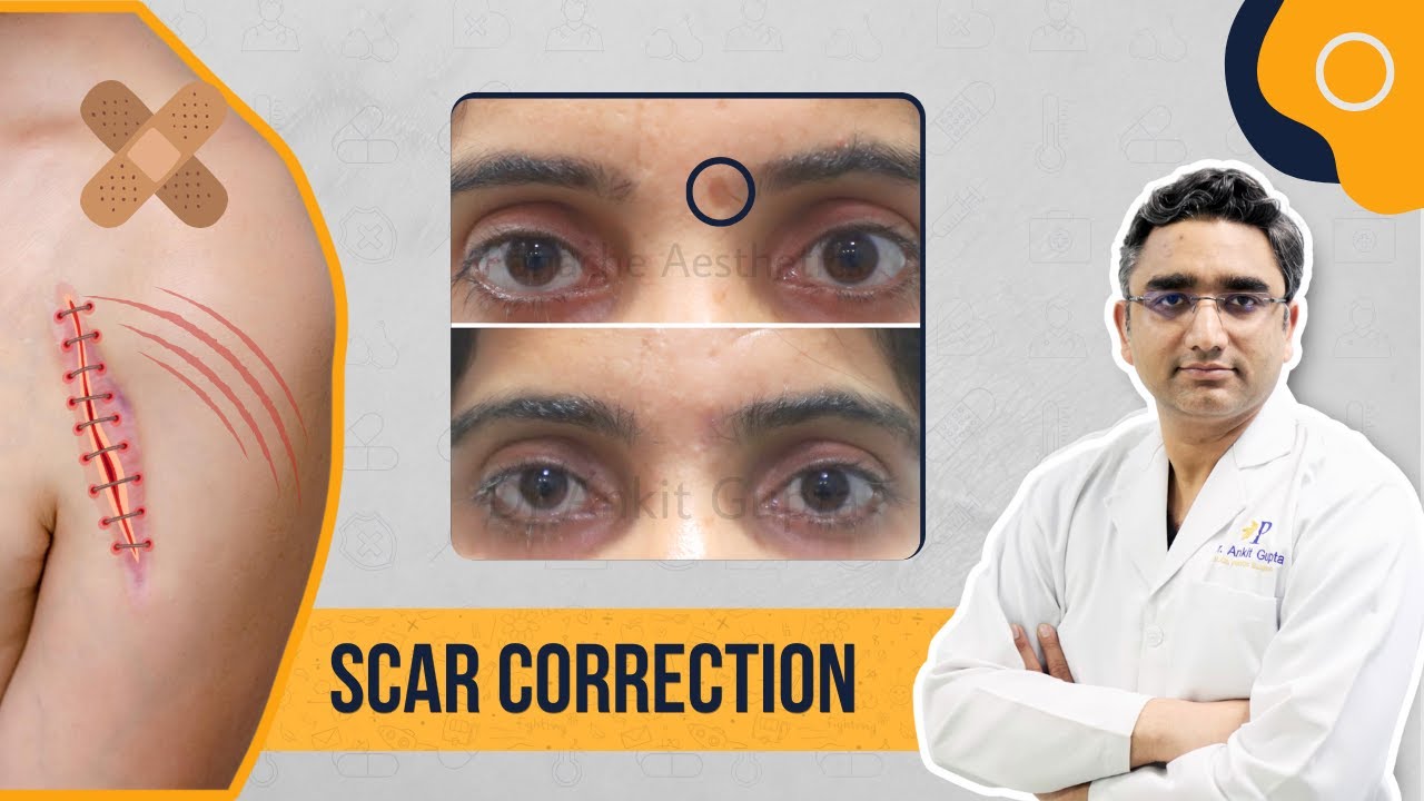 Old Facial Scar? Facial Scar Revision Surgery | Before & After Result ...