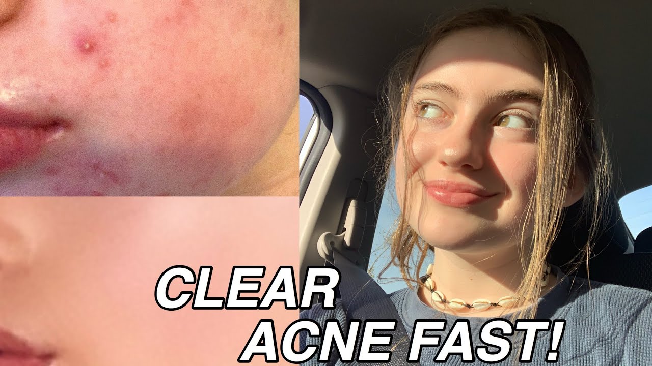 HOW TO REALLY CLEAR ACNE FAST !! // skincare routine - YouTube