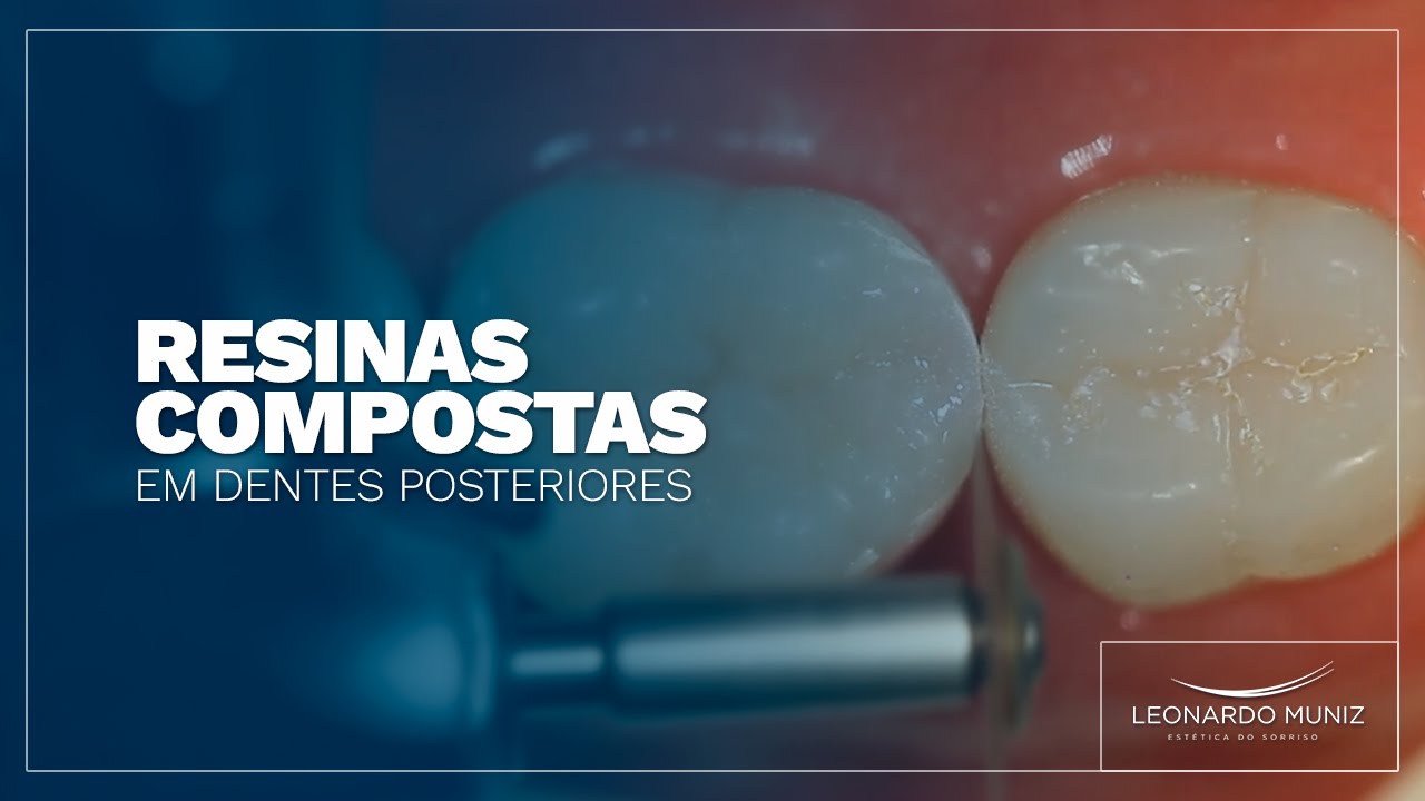 Resinas Compostas em Dentes Posteriores - YouTube