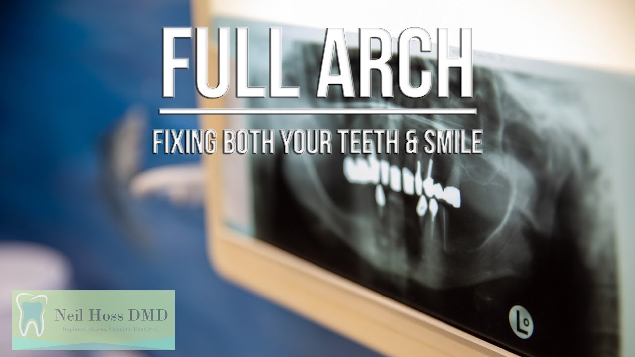 Options for replacing a full arch of teeth - YouTube