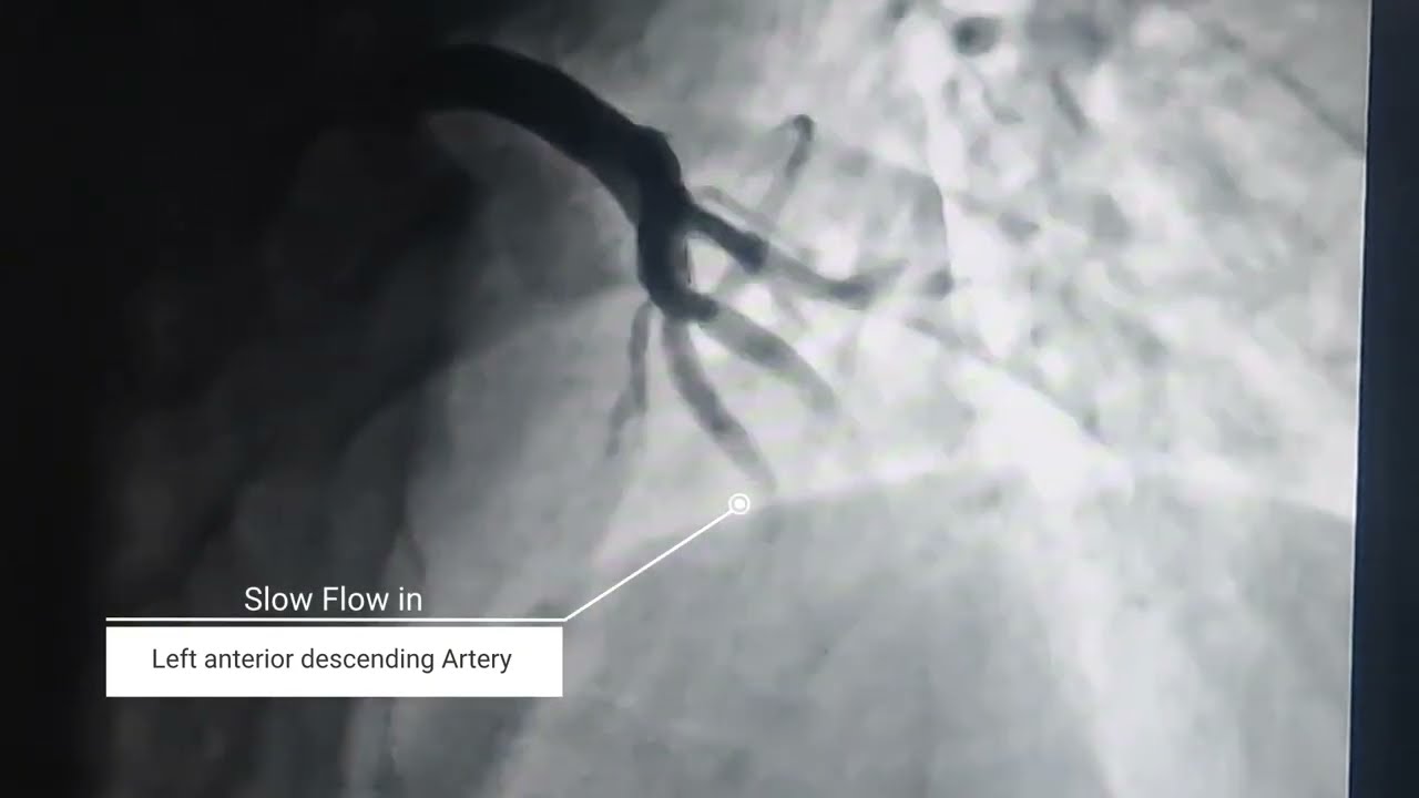 Slow flow in coronaries ll Slow flow in Angiography ll कोरोनरी आर्टरी ...
