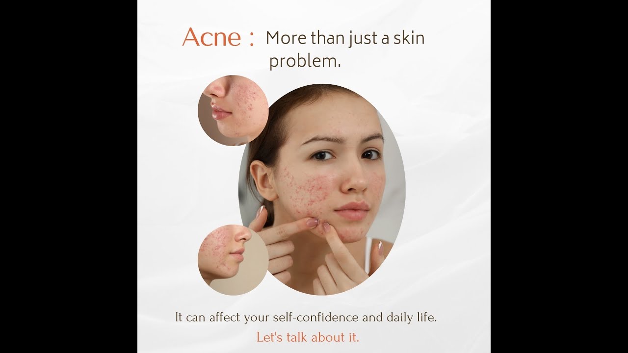 Achieve Clear Skin with SkinCues Trio Serum Set | Top Acne Solutions in Nepal - YouTube