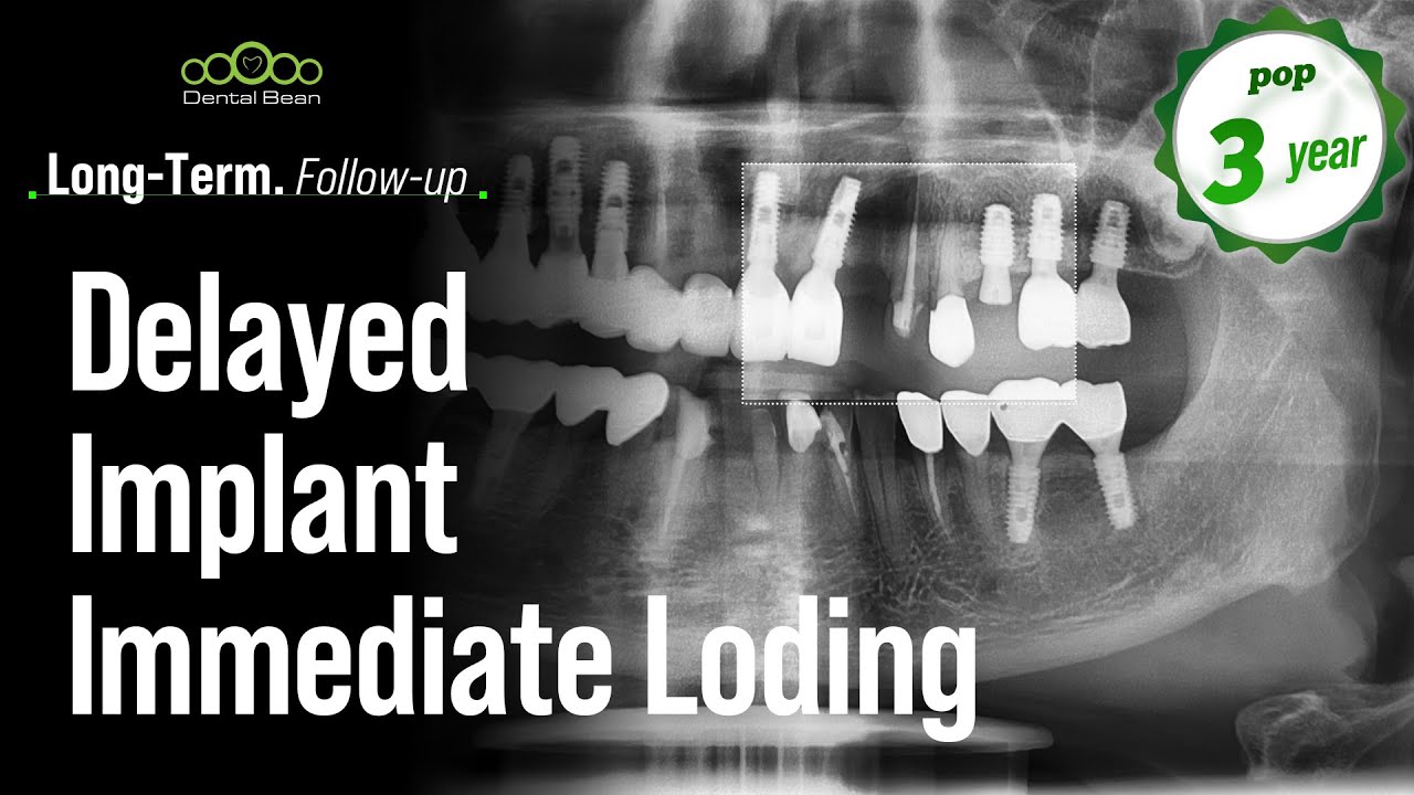Delayed Implant Placement with Immediate Loading, Bone Graft, ODS Resin ...