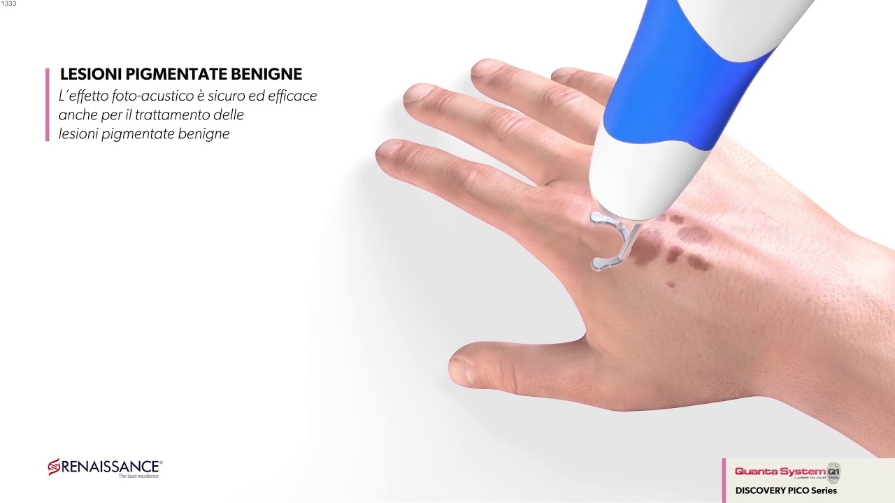 Renaissance lesioni pigmentate Discovery Pico by QUANTA SYSTEM - YouTube