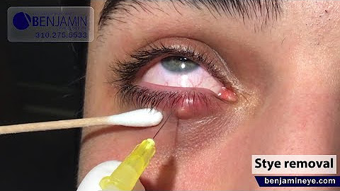 Stye removal procedure - YouTube