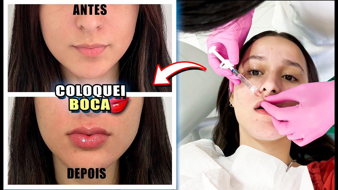 MNHA PRIMEIRA VEZ FAZENDO UM PREENCHIMENTO LABIAL! - YouTube