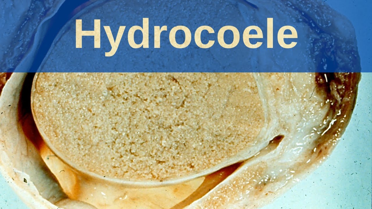 What is a Hydrocoele? - Pathology mini tutorial - YouTube