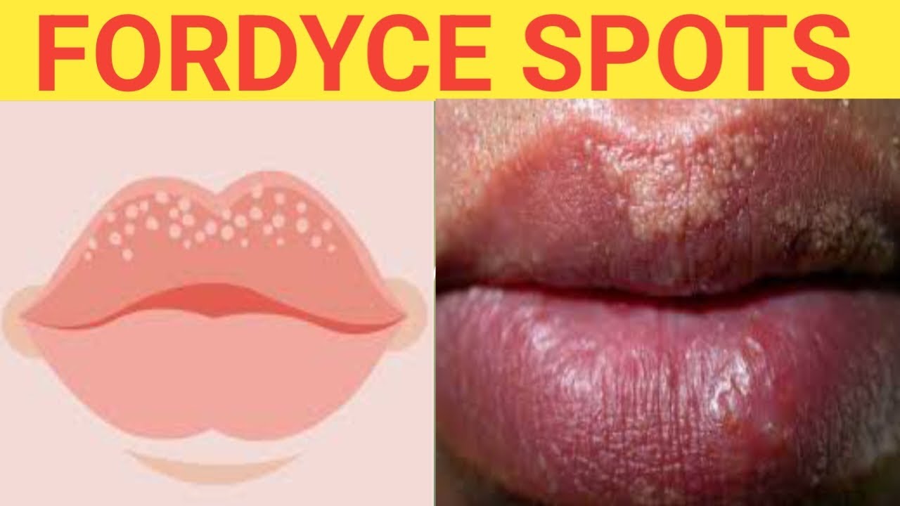 FORDYCE SPOTS ओंठ मे होने वाले सफेद और पीले दाने WHITE SPOT ON LIP ...