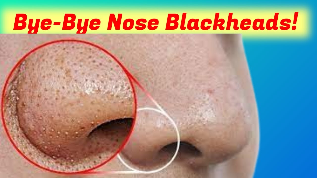 How Get Remove Blackheads On Nose | How Get Rid Blackheads On Nose ...
