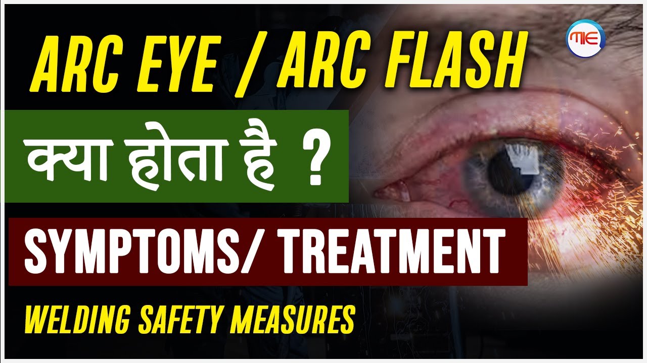 Arc Eye क्या होता है? Arc Flash क्या होता है ? Arc Flash Explained ...