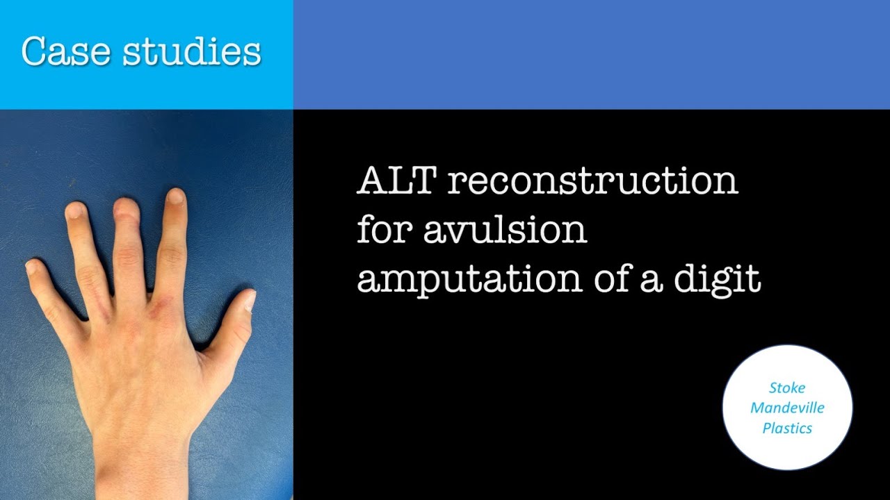 Free flap reconstruction for avulsion amputation of a finger - YouTube