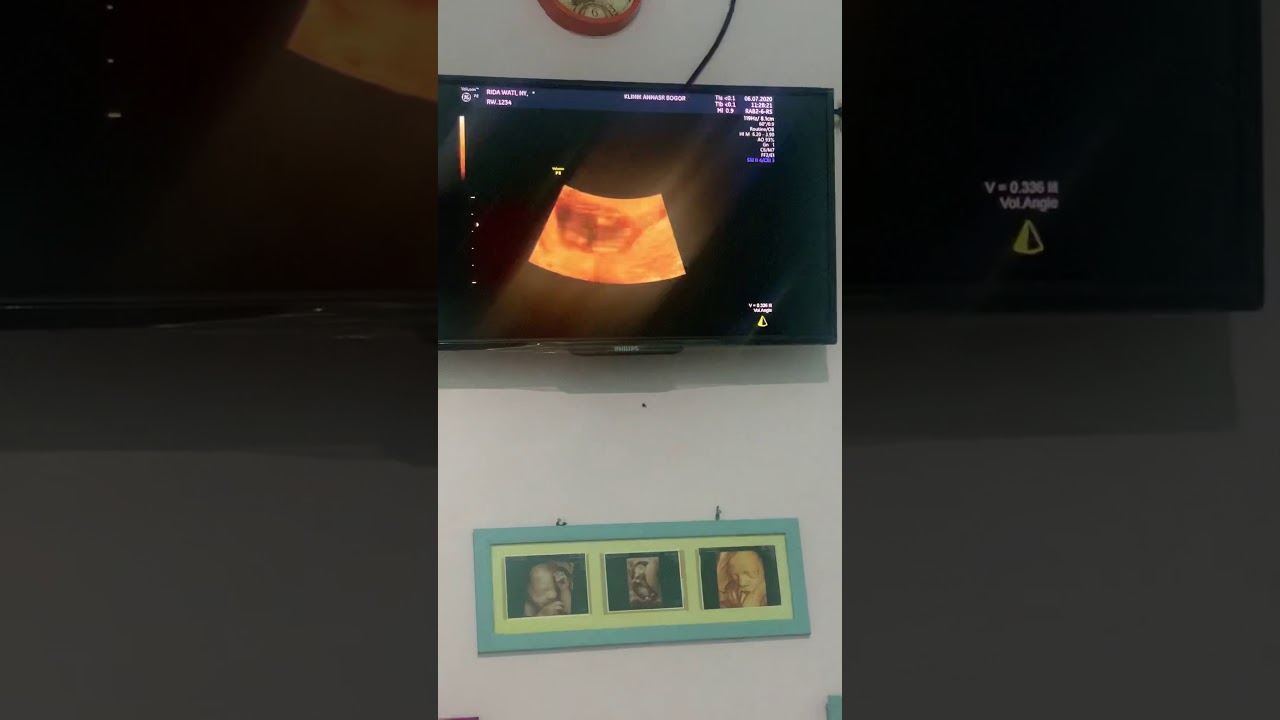 Perkembangan bayi 12 minggu/3 bulan dengan USG - YouTube