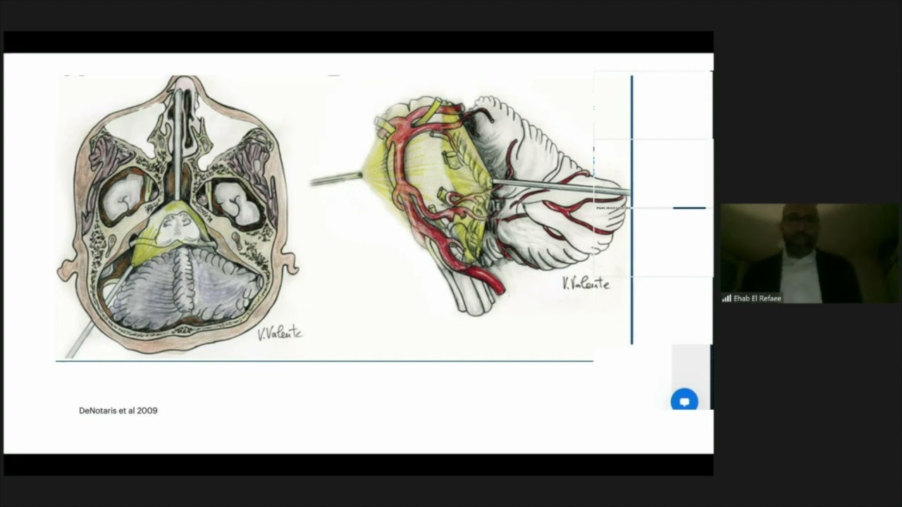 Endoscope assisted microvascular decompression for hemifacial spasm ...