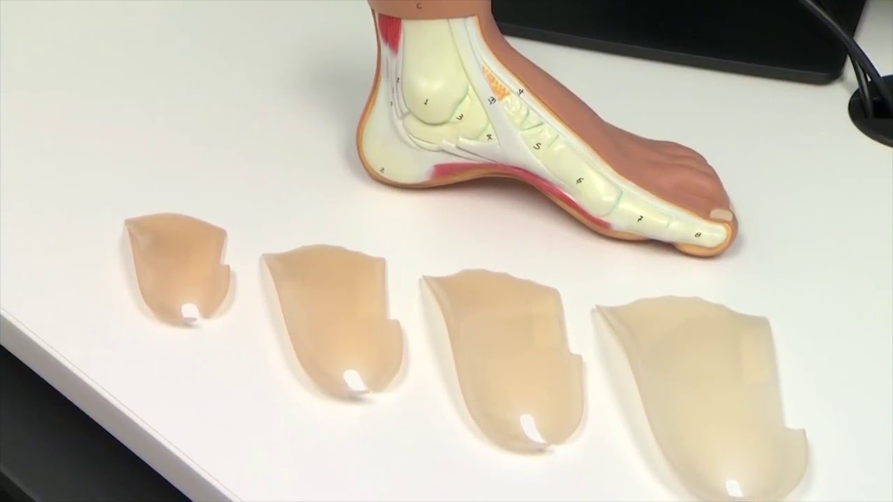 Podiatre Francois Giroux Technologie Orthèse Cryos - YouTube