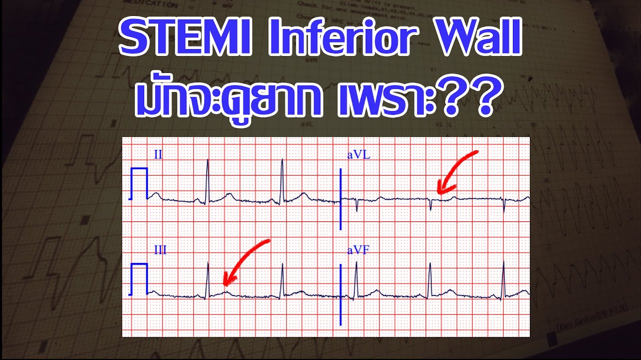 คลิปนี้จะช่วยให้คุณวินิจฉัย STEMI inferior wall ได้ดีขึ้น | Frontline ...