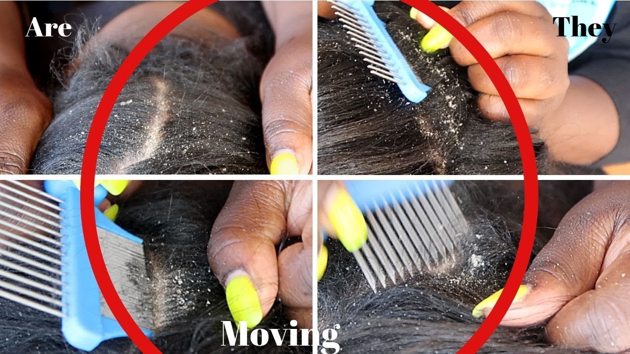 Scalp Scratch with Lice Comb. Nothing is moving. - YouTube