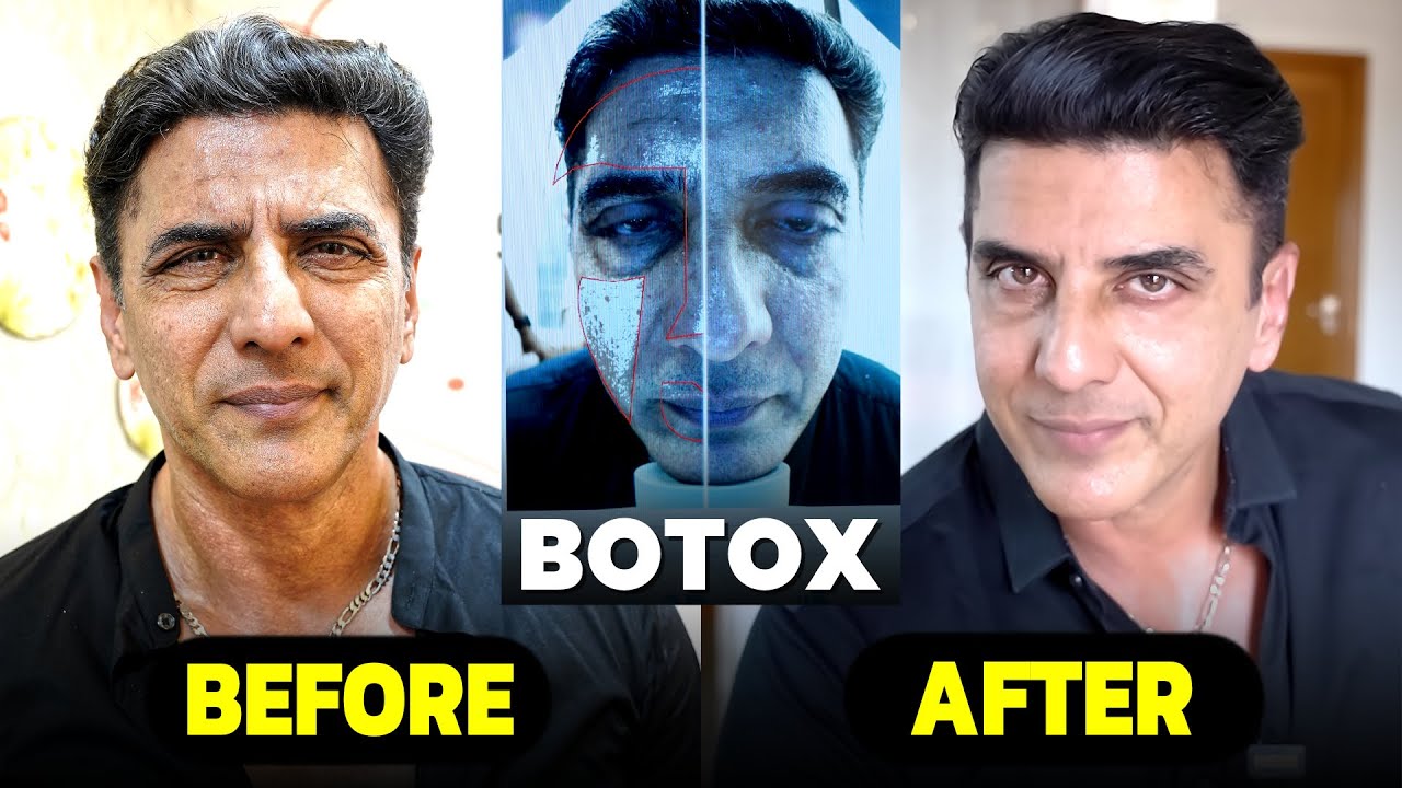 எப்படி இருந்த நான் இப்படி ஆகிட்டேன் 🫢| Full Face Botox Treatment | King ...