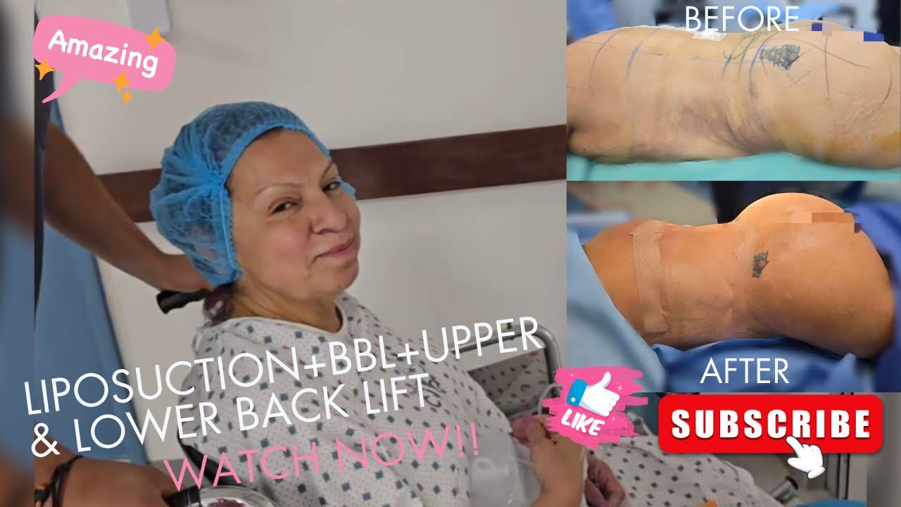 Liposuction + BBL + Upper & Lower Back Lift #muñecasbodies # ...