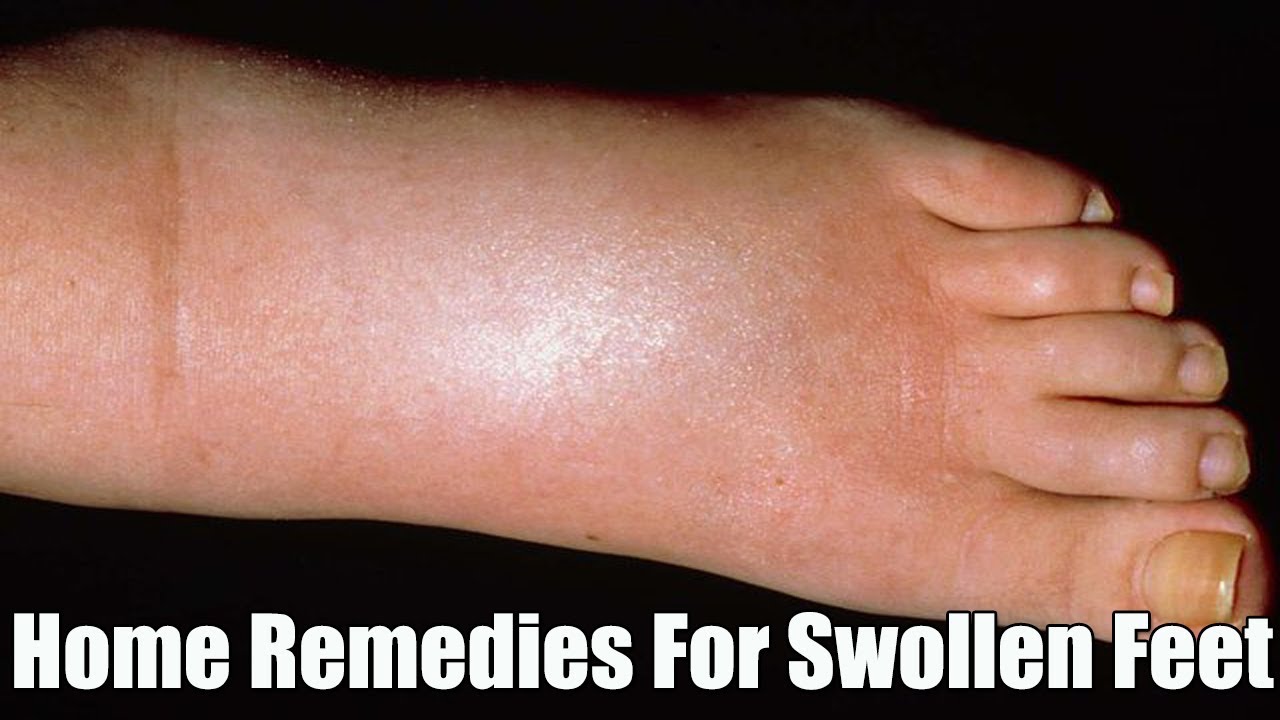 5 effective home remedies for swollen feet - YouTube