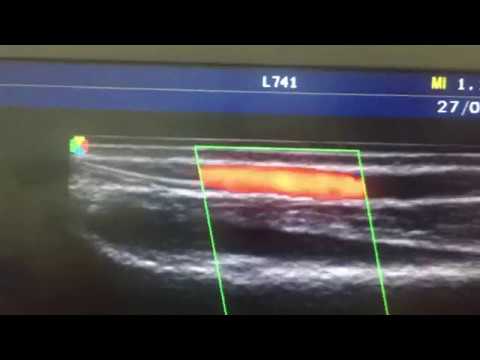LINEA ARTERIAL RADIAL CON ECOGRAFIA - YouTube