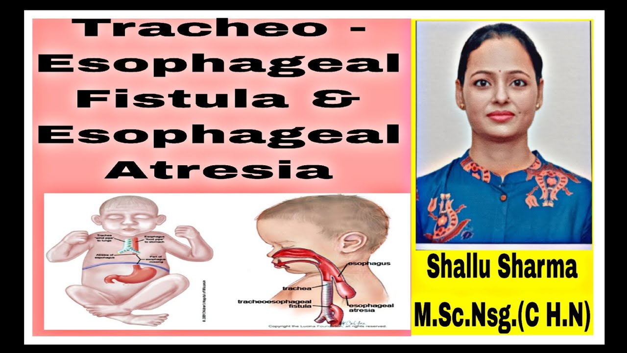Tracheo - esophageal fistula and Esophageal atresia|| TEF and EA ...