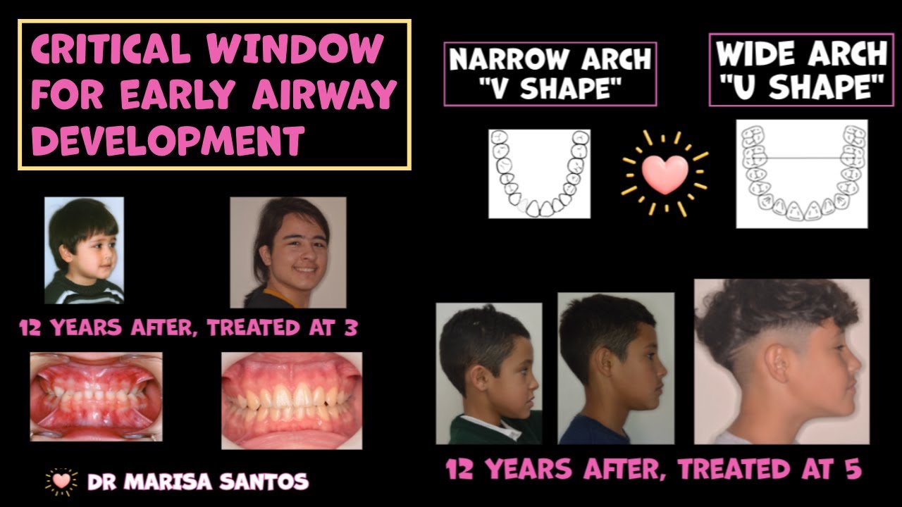 CRITICAL WINDOW FOR EARLY AIRWAY DEVELOPMENT W DR MARISA SANTOS - YouTube