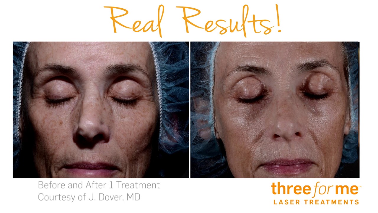 Cynosure Icon© Three For Me - YouTube