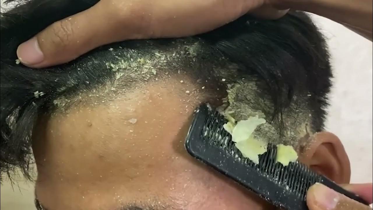Dry Scalp Big Flakes Dandruff Scratching 😲 18 Youtube