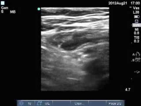Ultrasound compression test for DVT- Left Common Femoral Vein- DVT ...