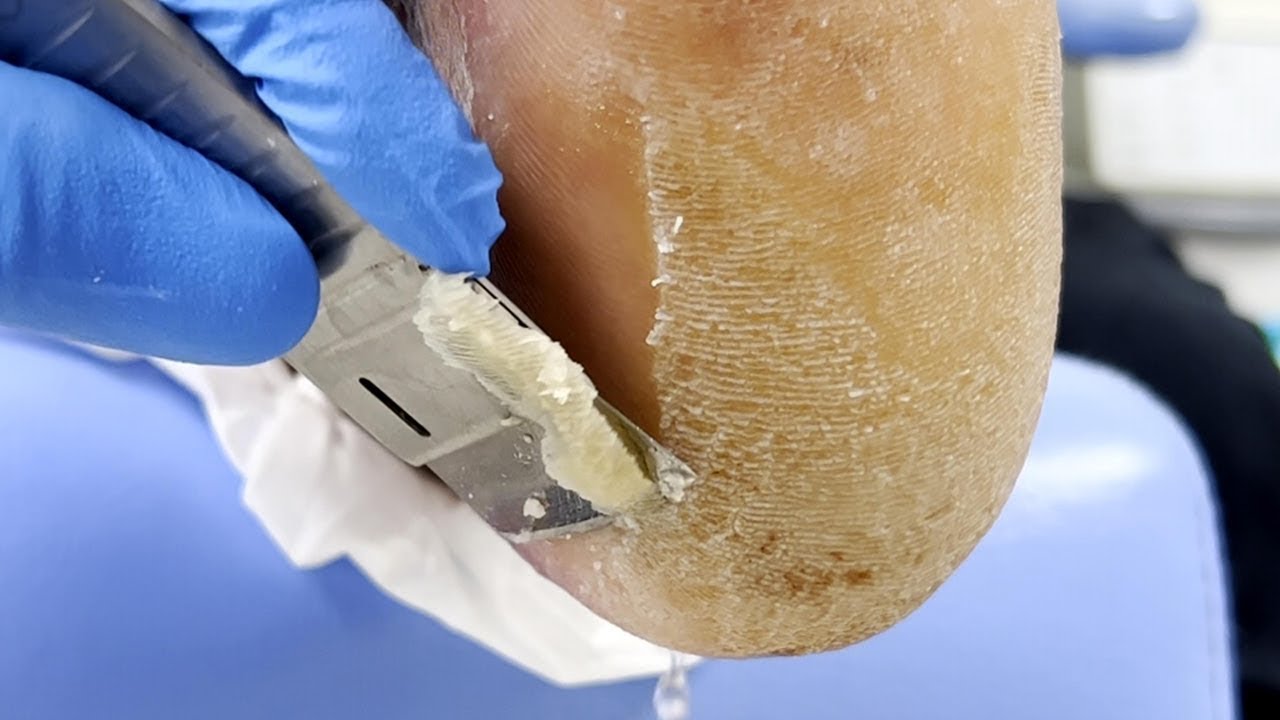 The Dead Skin On The Soles Of The Feet Is Scraped Off Like Snowflakes the-dead-skin-on-the-soles-of-the-feet-is-scraped-off-like-snowflakes