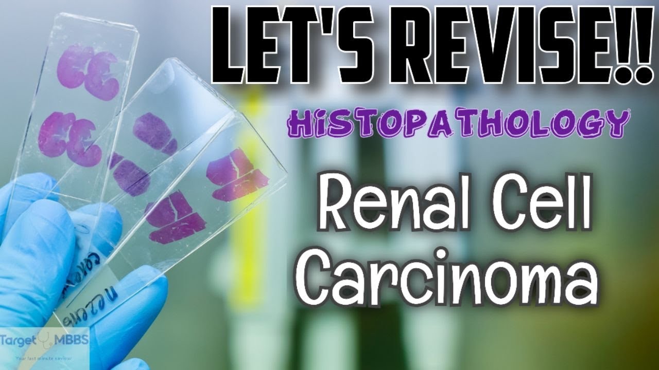 HISTOPATHOLOGY | RENAL CELL CARCINOMA | Target MBBS | PATHOLOGY ...