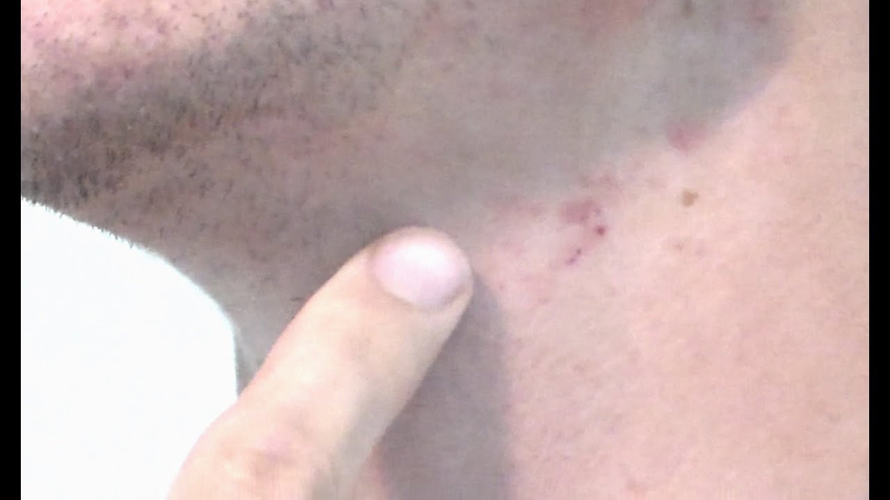 Evidence of Alien Neck Injection - YouTube