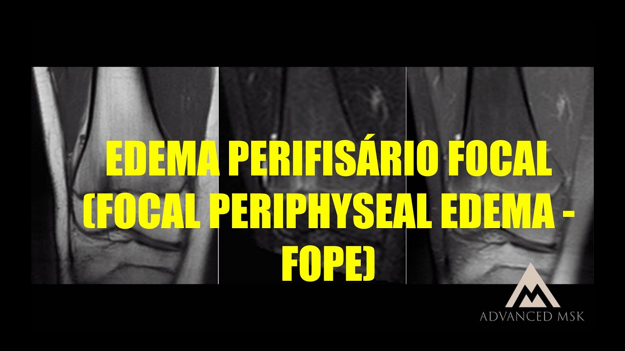 Caso #13 - Edema perifisário focal (focal periphyseal edema – FoPE ...