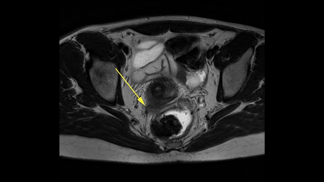 Full time 25 min excision of rectovaginal endometriosis (didactic movie ...