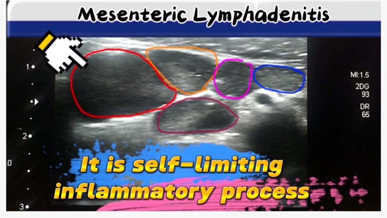 How to check your lymph nodes | Mesenteric adenitis vs Appendicitis ...