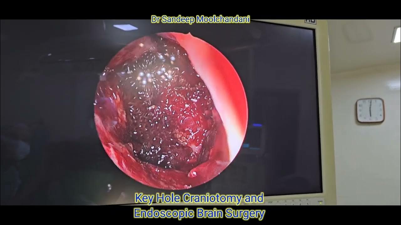 Key Hole Craniotomy and Endoscopic Brain Surgery | Dr Sandeep Moolchandani - YouTube