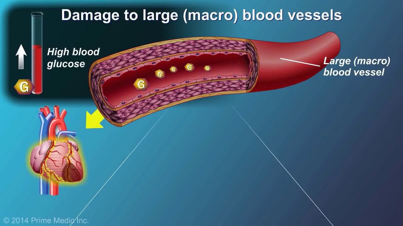Type 2 Diabetes Animation - YouTube