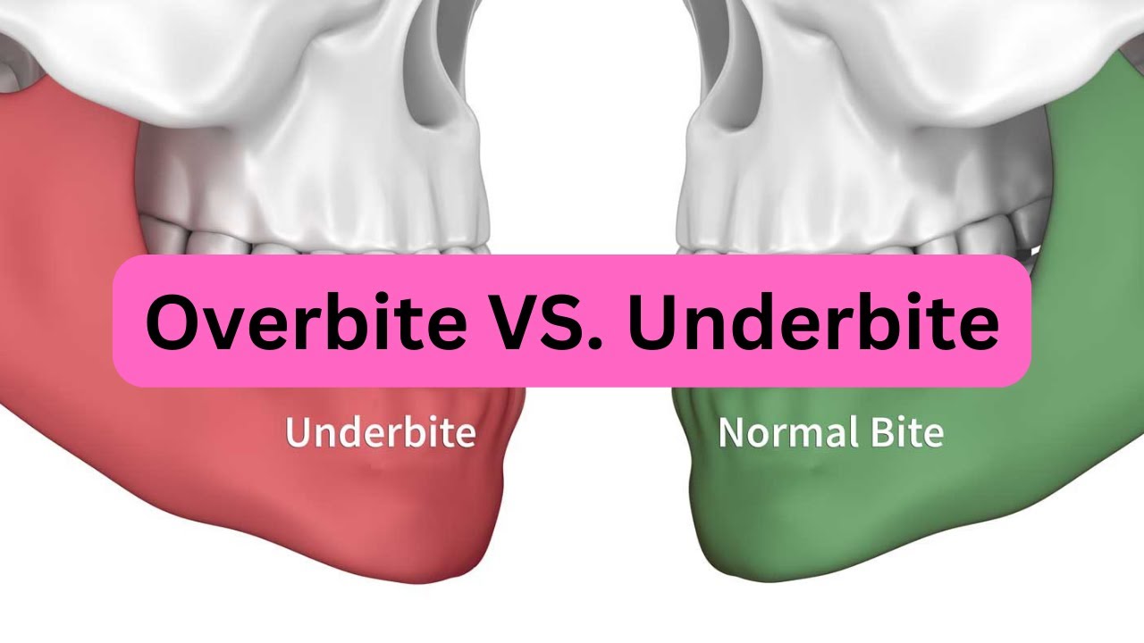 Difference between overbite and underbite! Way to easy remember them ...