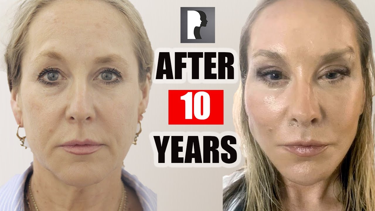 Over 10years of plastic surgery research and surgery...Vertical FACE ...