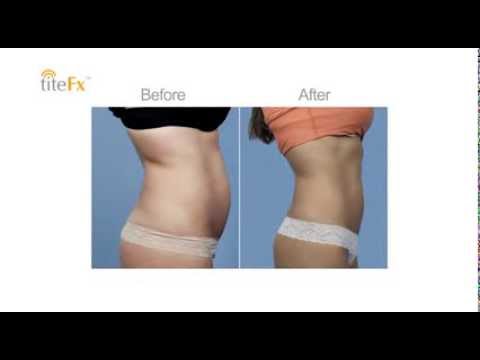 Tite FX Non-Surgical Fat Removal with Dr. Theodore Diktaban