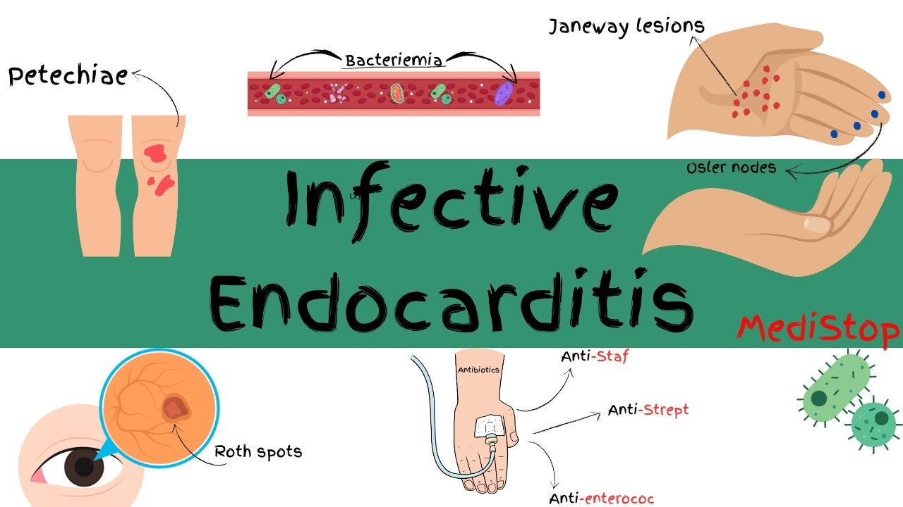 Infective Endocarditis | Pathophysiology, Signs(with Duke Criteria ...
