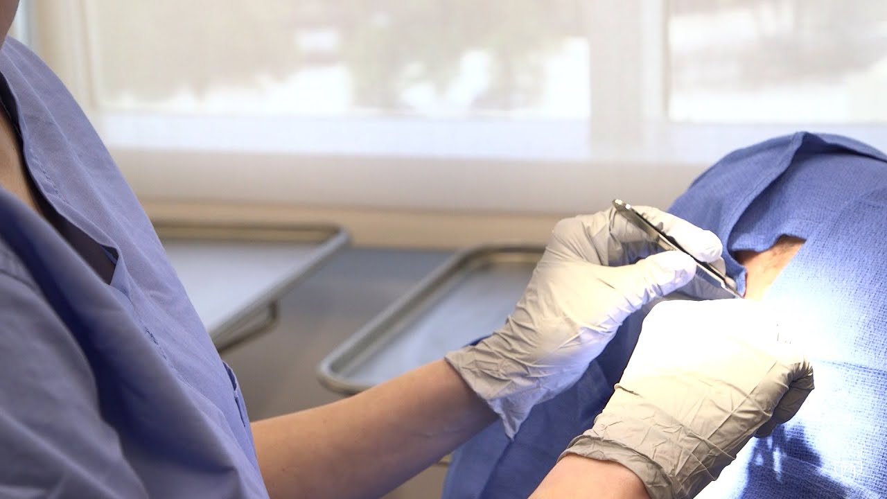 Mayo Clinic Minute: Treating skin cancer with Mohs surgery - YouTube