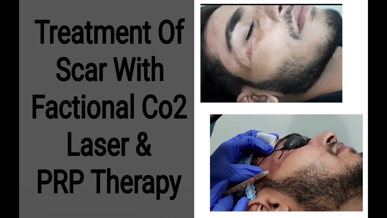 Treatment Of Scar With Factional Co2 Laser & PRP Therapy - YouTube
