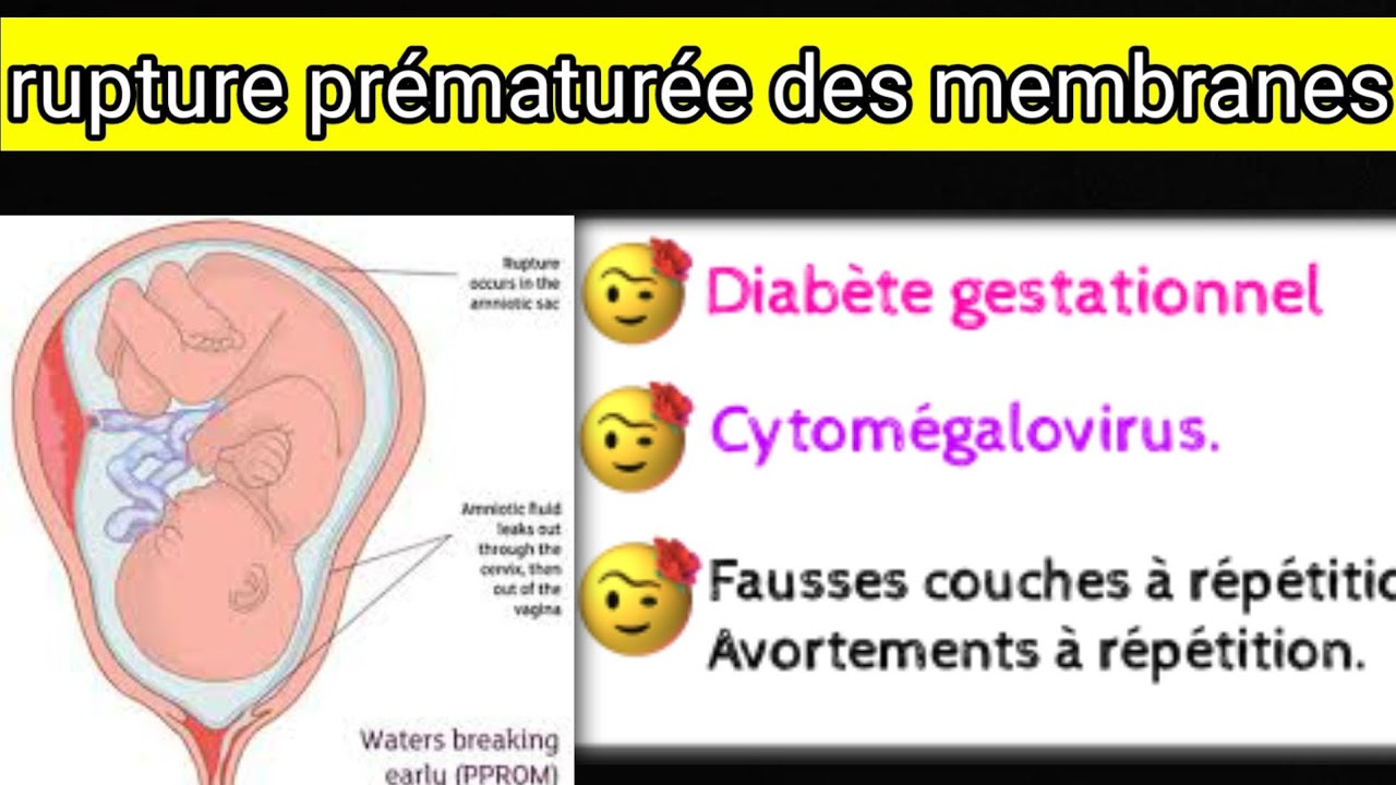 rupture prématurée des membranes - YouTube