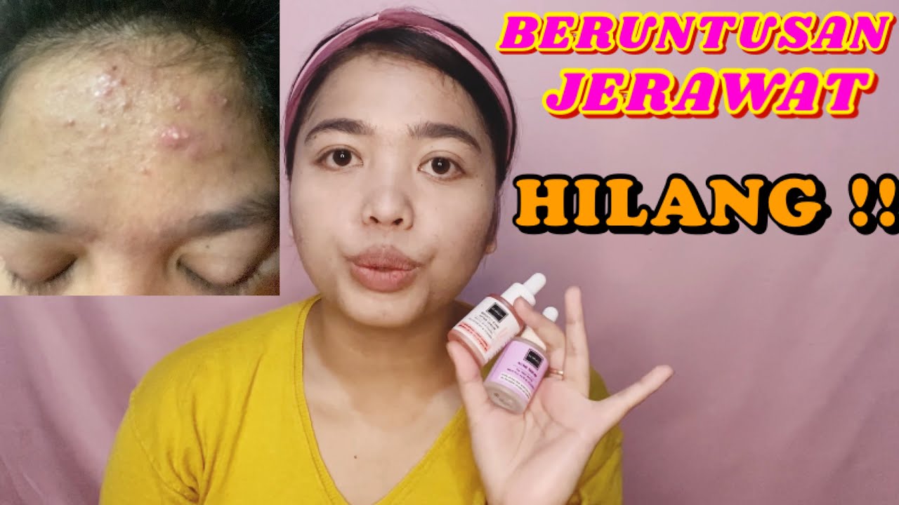 CARA MENYEMBUHKAN JERAWAT DENGAN CEPAT MENGGUNAKAN ACNE SERUM SCARLETT WHITENING - YouTube