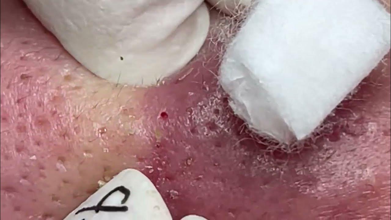 Sac Dep Spa 𝐁𝐢𝐠 𝐂𝐲𝐬𝐭𝐢𝐜 𝐀𝐜𝐧𝐞 𝐁𝐥𝐚𝐜𝐤𝐡𝐞𝐚𝐝𝐬 𝐄𝐱𝐭𝐫𝐚𝐜𝐭𝐢𝐨𝐧 𝐁𝐥𝐚𝐜𝐤𝐡𝐞𝐚𝐝𝐬 #941 - YouTube