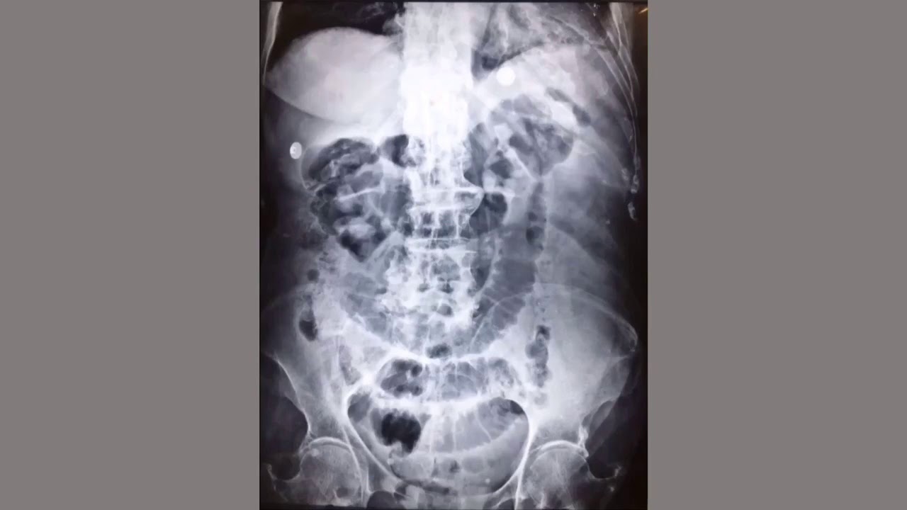 Obstrucción Intestinal, caso clínico - YouTube