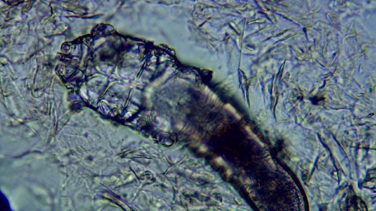 DEMODEX.모낭충.모낭충현미경.DEMODEX MICROSCOPE. - YouTube