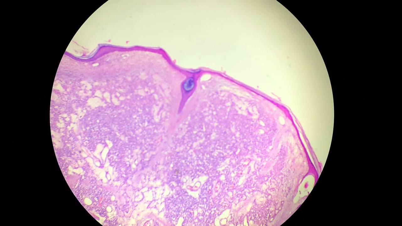 Pyogenic granuloma - YouTube