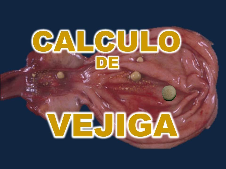 CALCULO DE VEJIGA - YouTube